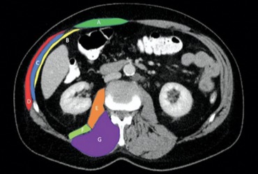 Hernia Radiology: Your Road Map to Operative Success