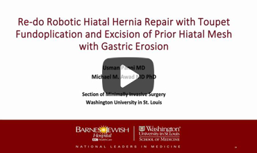 SAGES 2025 Robotic Hiatal Hernia Repair Toupet Fundoplication Excision ...